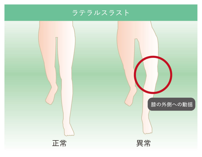 変形性膝関節症におけるインソール（足底板）について - 整形外科医師による関節の痛み情報サイト